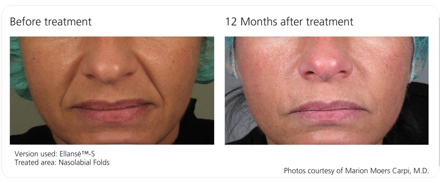 Ellanse Dermal Filler